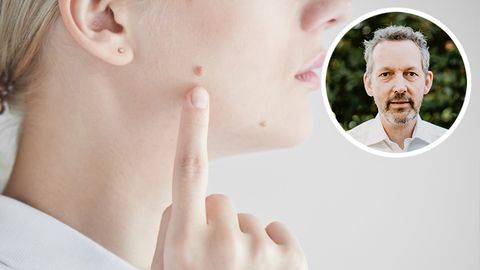 Muttermale: Woran erkenne ich, ob sie bedenklich sind? - [GEO]