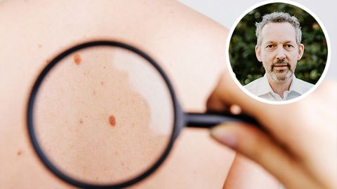 Hautkrebs: So unterscheiden sich Formen und Therapien - [GEO]