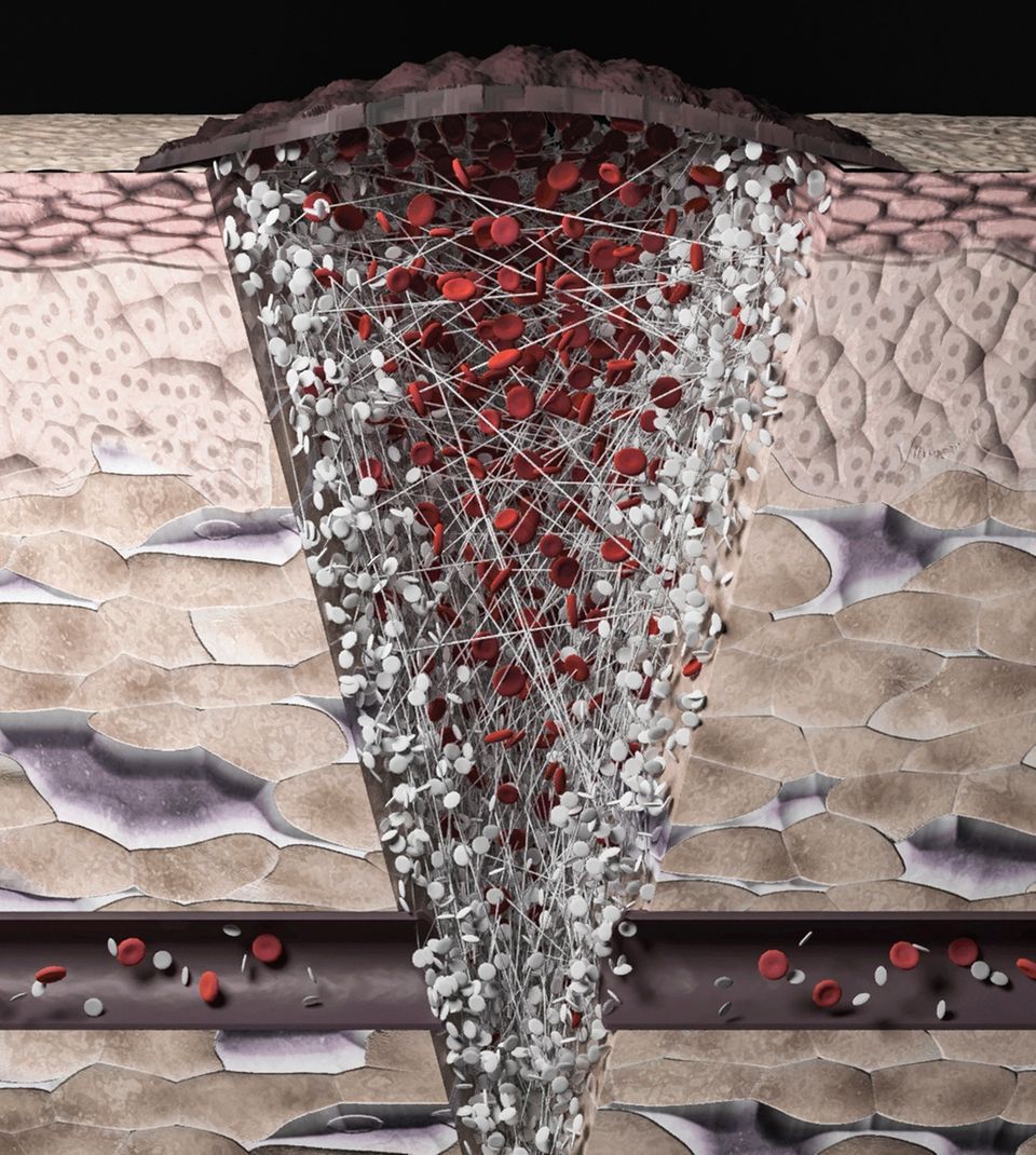 Die vier Schritte der Wundheilung - [GEO]