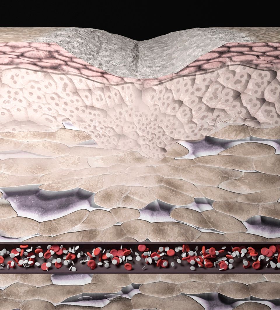 Die vier Schritte der Wundheilung - [GEO]