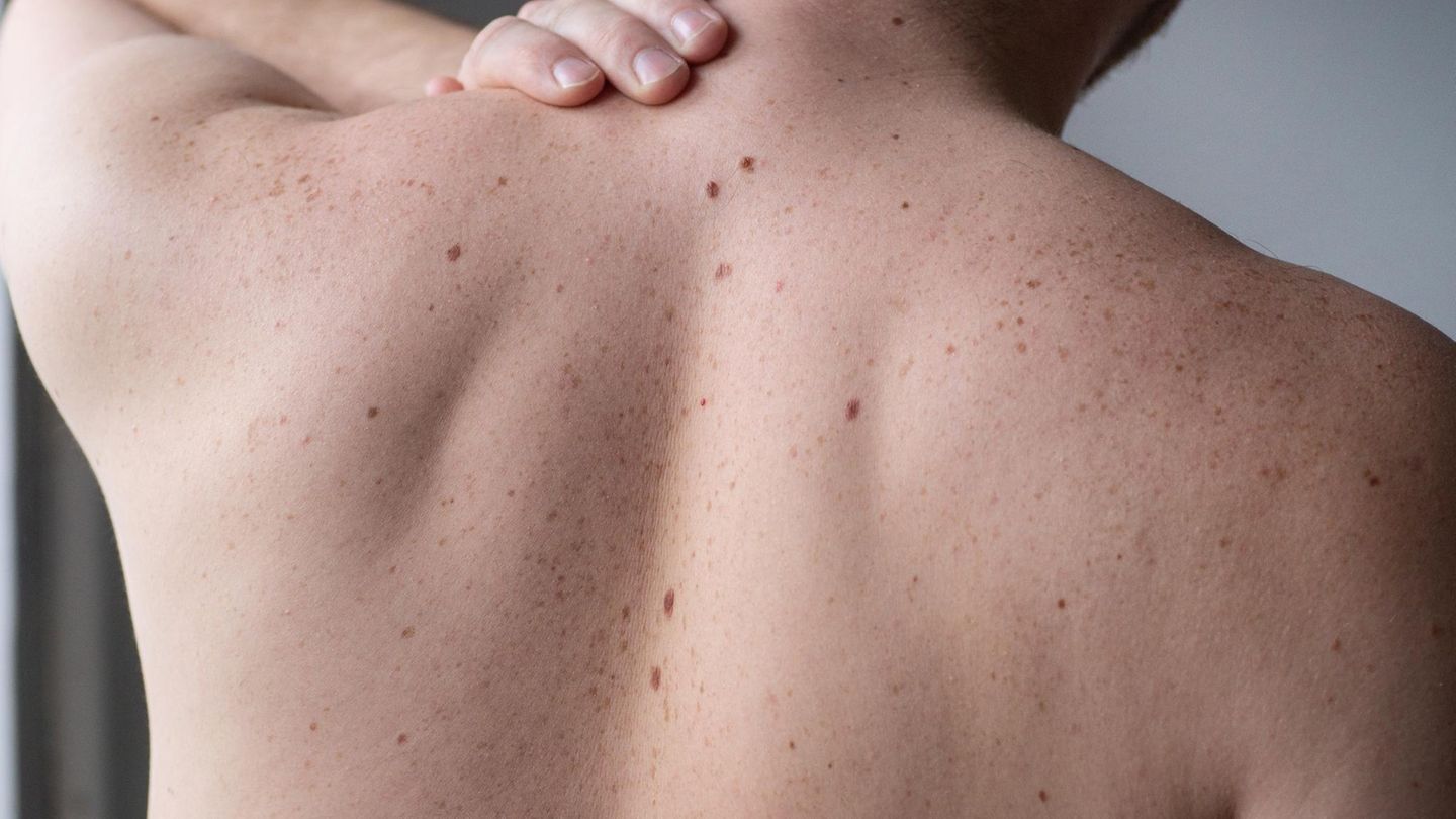 Krebserkrankungen: Hautkrebs-Fälle in Kliniken binnen 20 Jahren fast ...